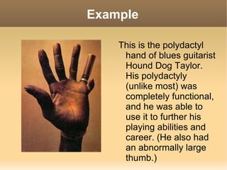 Polydactyly | PPT