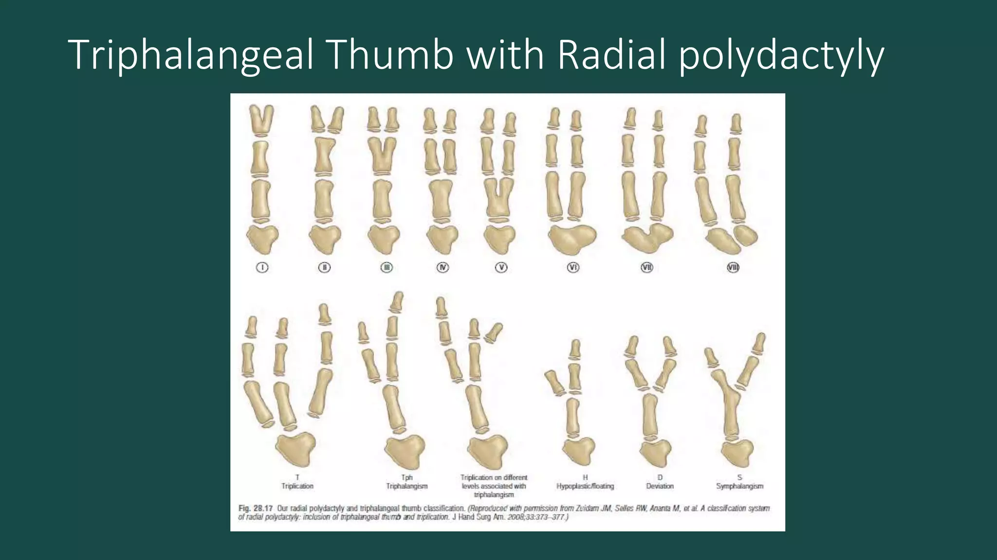 Polydactyly | PPTX