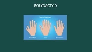 Polydactyly | PPTX