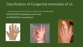 Polydactyly | PPTX
