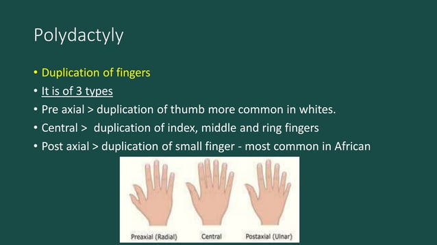 Polydactyly | PPTX | Death, Injury, or Military Conflict | Sensitive Topics