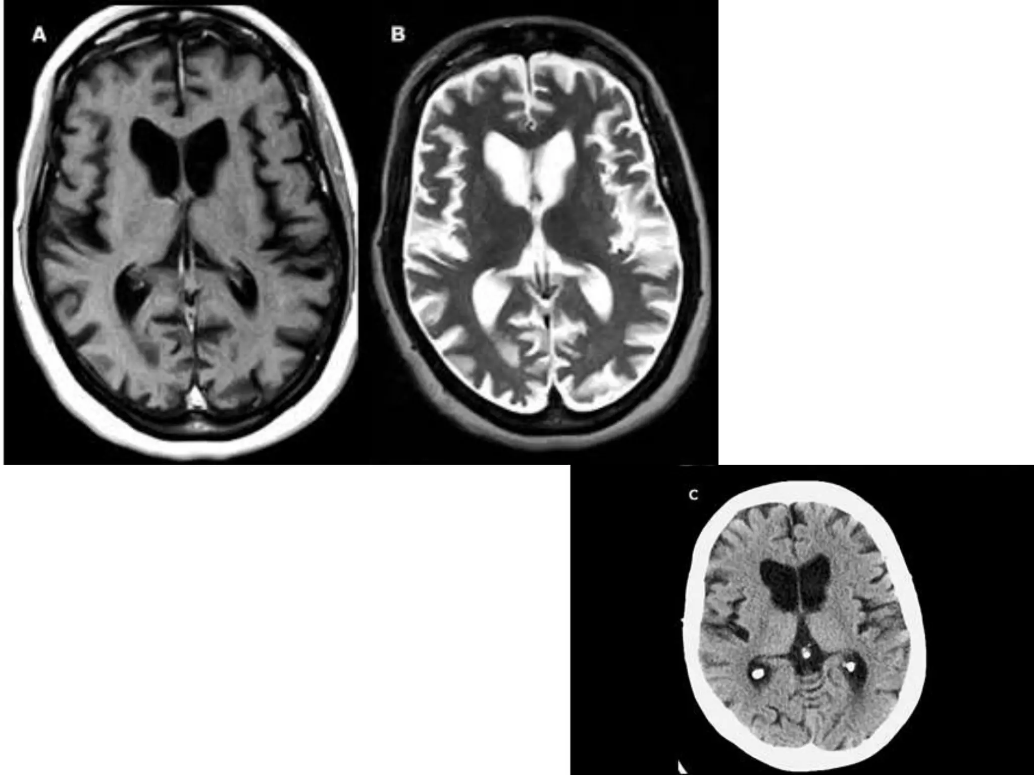 Polyglutaminedisorders | PPT