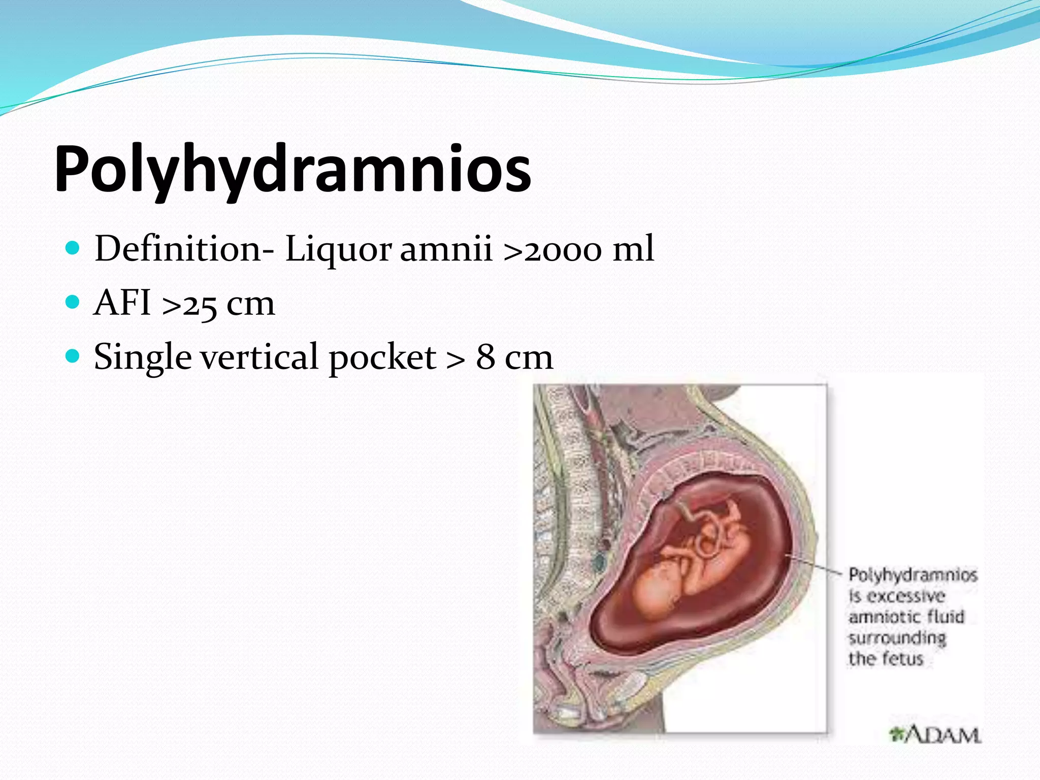 Polyhydramnios | PPTX