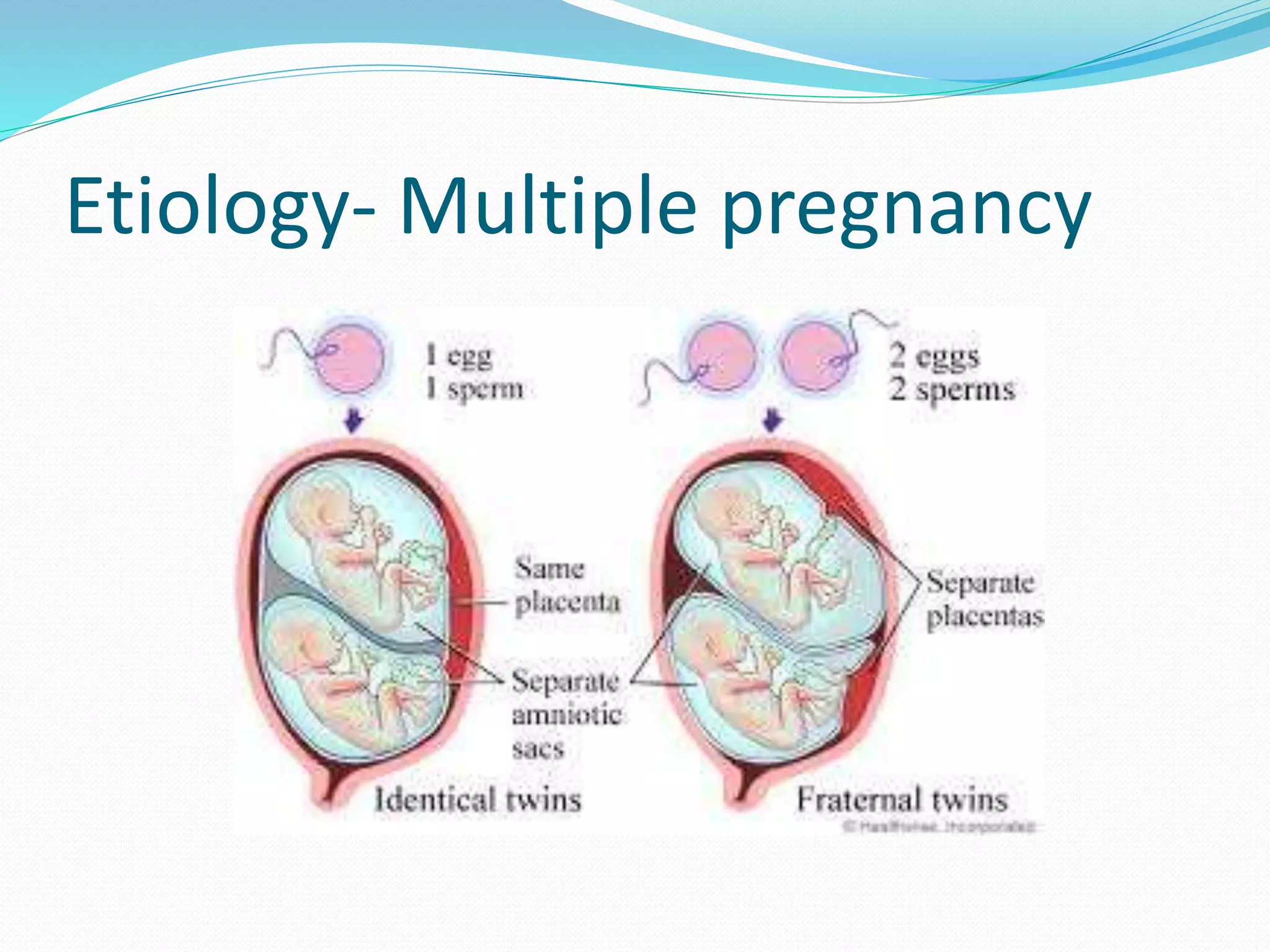 Polyhydramnios | PPTX