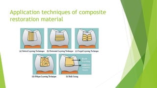 polymerization shrinkage in composite restoration.pptx