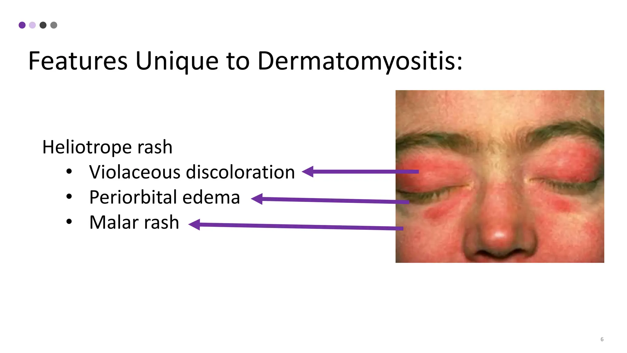 Exploring Polymyositis and Dermatomyositis: Understanding the ...