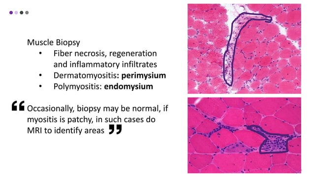 Exploring Polymyositis and Dermatomyositis: Understanding the ...