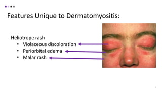Exploring Polymyositis and Dermatomyositis: Understanding the ...