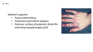 Exploring Polymyositis and Dermatomyositis: Understanding the ...