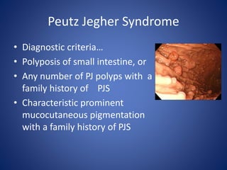 Polypoid diseases of git | PPTX