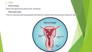 POLYPS Medical Surgical Nursing presentation | PDF