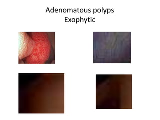 Colorectal Polyps & Carcinomas Diagnosis & characterization | PPTX