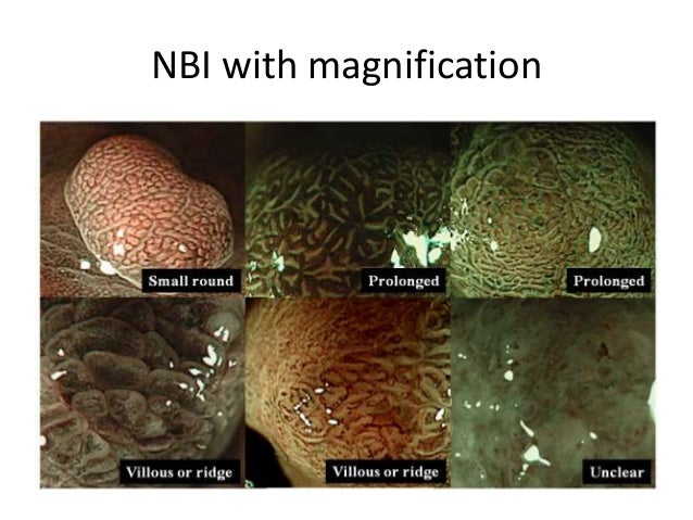 Colorectal Polyps & Carcinomas Diagnosis & characterization
