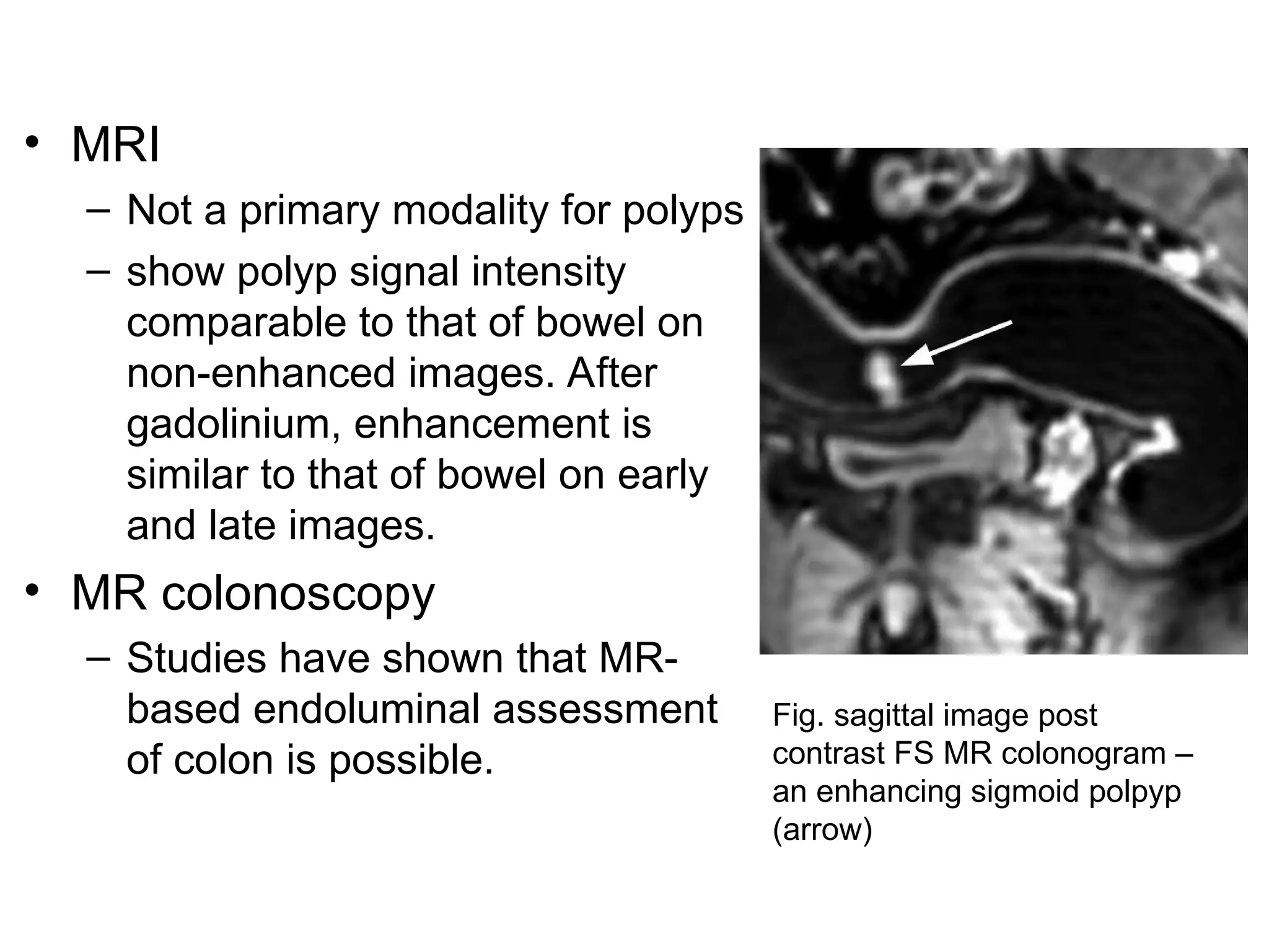 polypsandmalignancyoflargebowel-190525120300.ppt