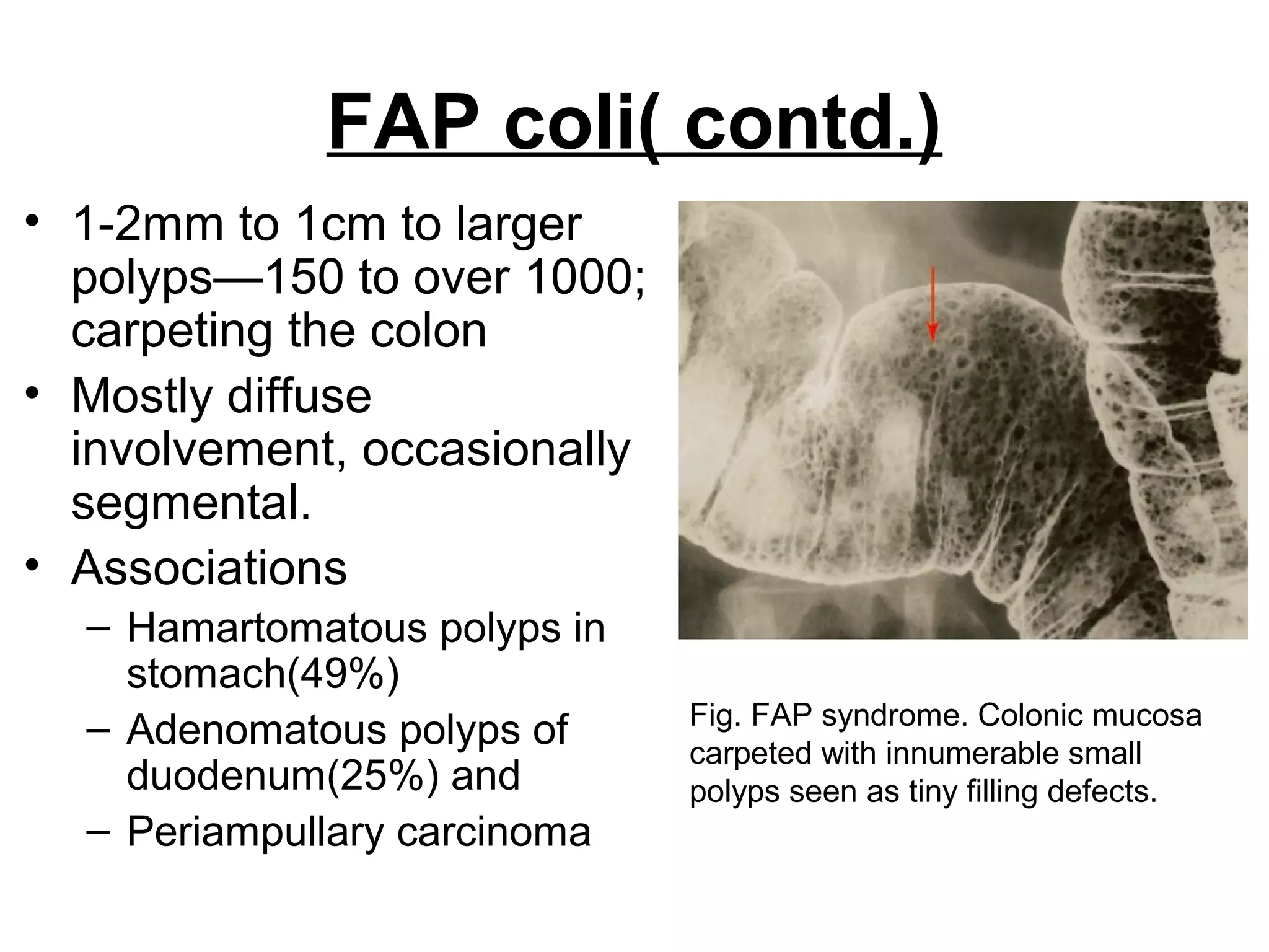 Polyps and malignancy of large bowel | PPT