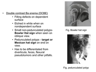 Polyps and malignancy of large bowel | PPT