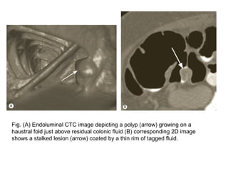 Polyps and malignancy of large bowel | PPT