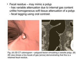 Polyps and malignancy of large bowel | PPT