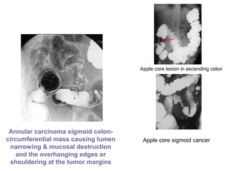 Polyps and malignancy of large bowel | PPT