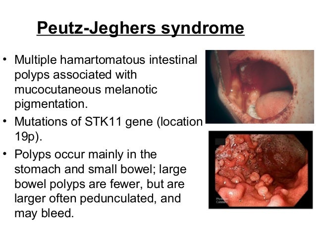 Polyps and malignancy of large bowel