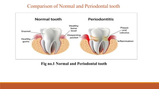 Polysaccharide Based Drug Delivery System for Periodontitis-PPT.pptx