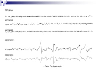 Polysomnogram interpretation by dr md abdullah saleem | PPTX