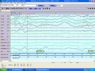 Polysomnography: recording and sleep staging | PPT