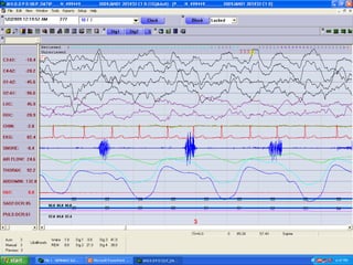 Polysomnography: recording and sleep staging | PPT