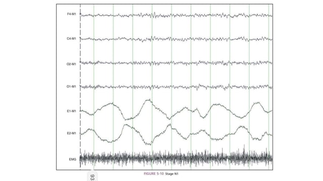Polysomnography | PPTX