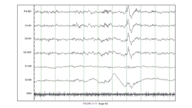 Polysomnography | PPTX