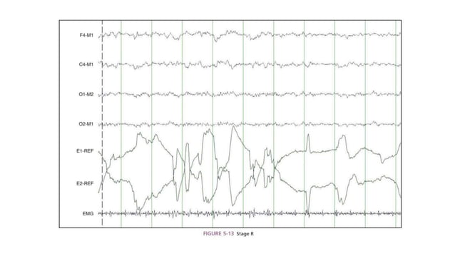 Polysomnography | PPTX