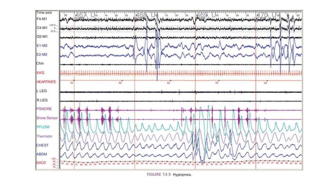 Polysomnography | PPTX