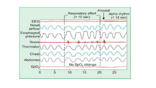 Polysomnography | PPTX