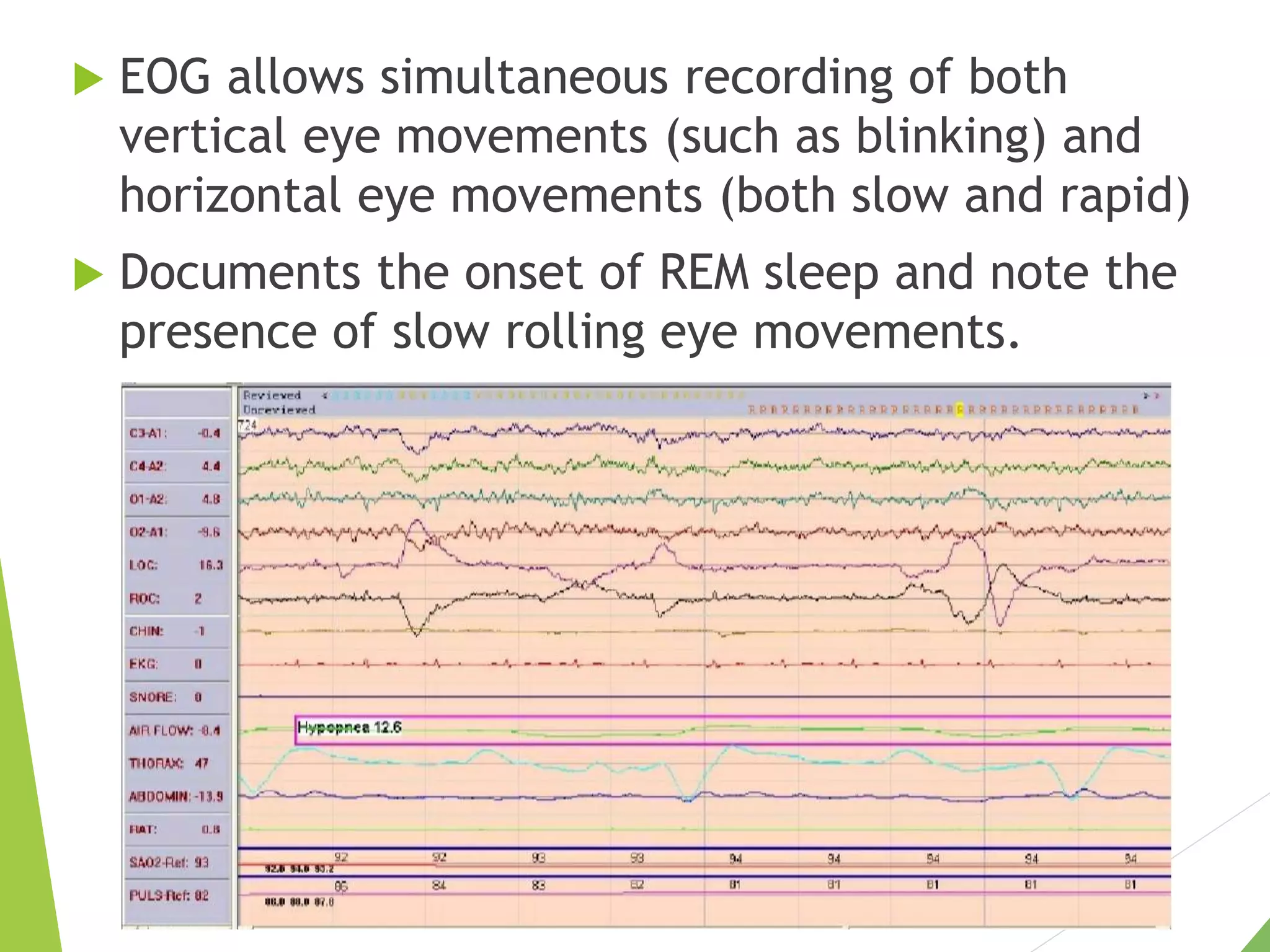 Polysomnography (sleep study) | PPTX