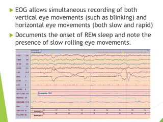 Polysomnography (sleep study) | PPTX