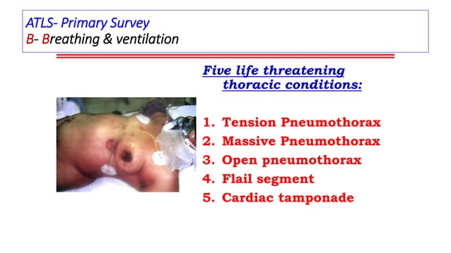 ATLS polytrauma_Final Mangement ASI 2.ppt