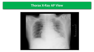 Poly trauma, intertrochanter, open fractur distal tibia.pptx