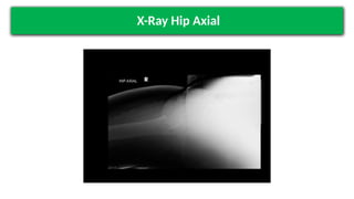 Poly trauma, intertrochanter, open fractur distal tibia.pptx