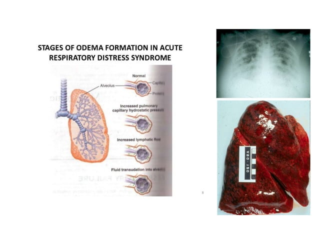 Polytrauma part 2 (ards) | PPT | Lung and Respiratory Health | Diseases ...