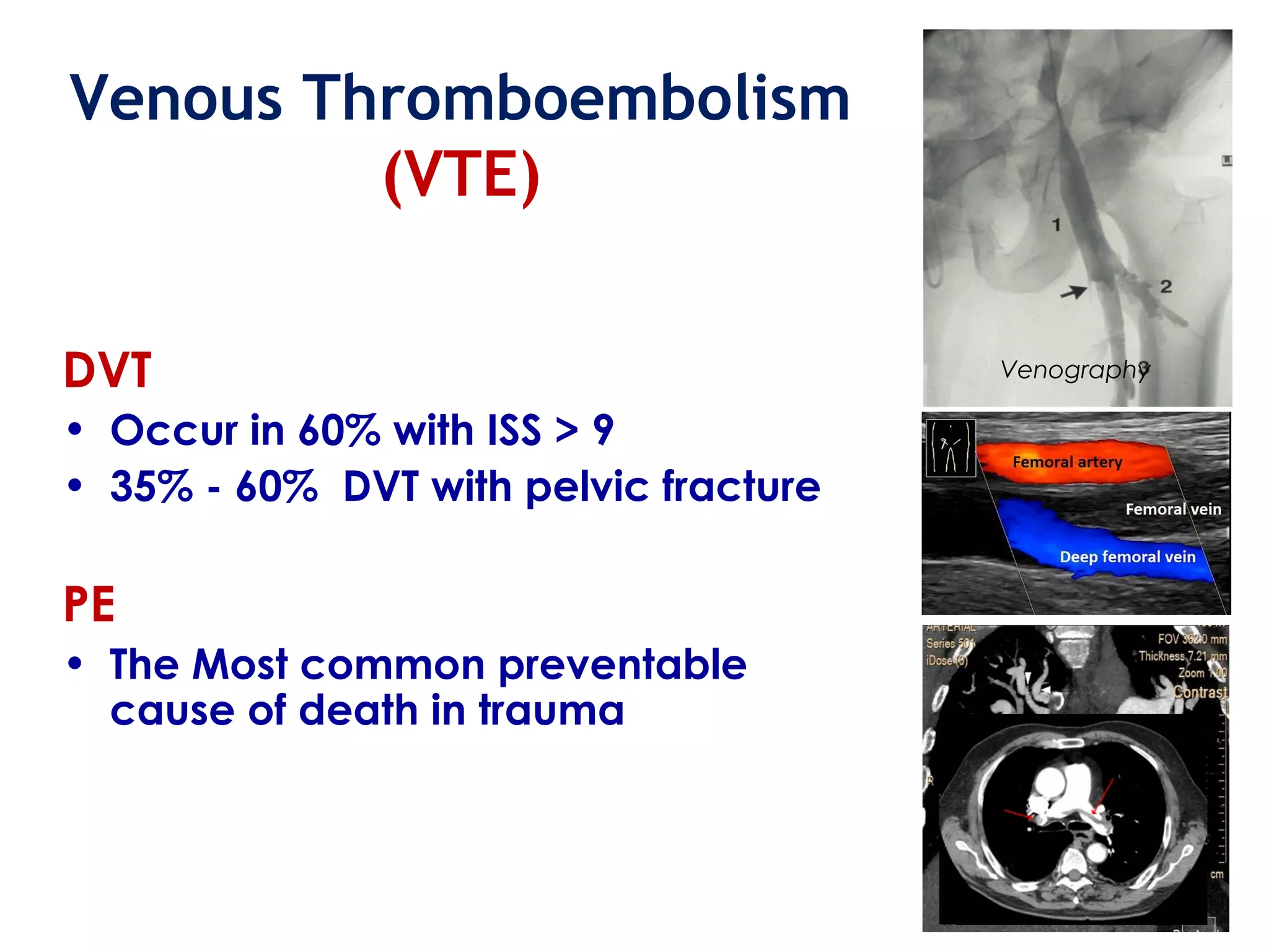 Polytrauma part 5 (VTE) | PPT