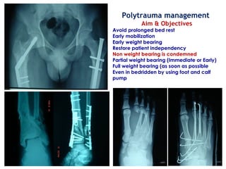 Polytrauma part 5 (VTE) | PPT