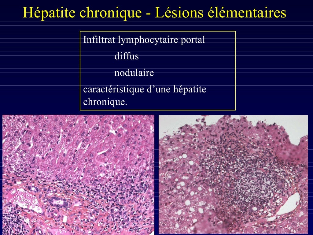 Ponction Biopsie Hépatique.ppt