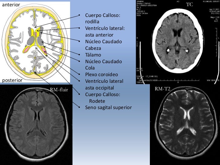 Anatomía para TC y TRM: Ventrículos Encefálicos