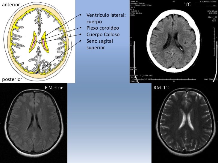 Anatomía para TC y TRM: Ventrículos Encefálicos