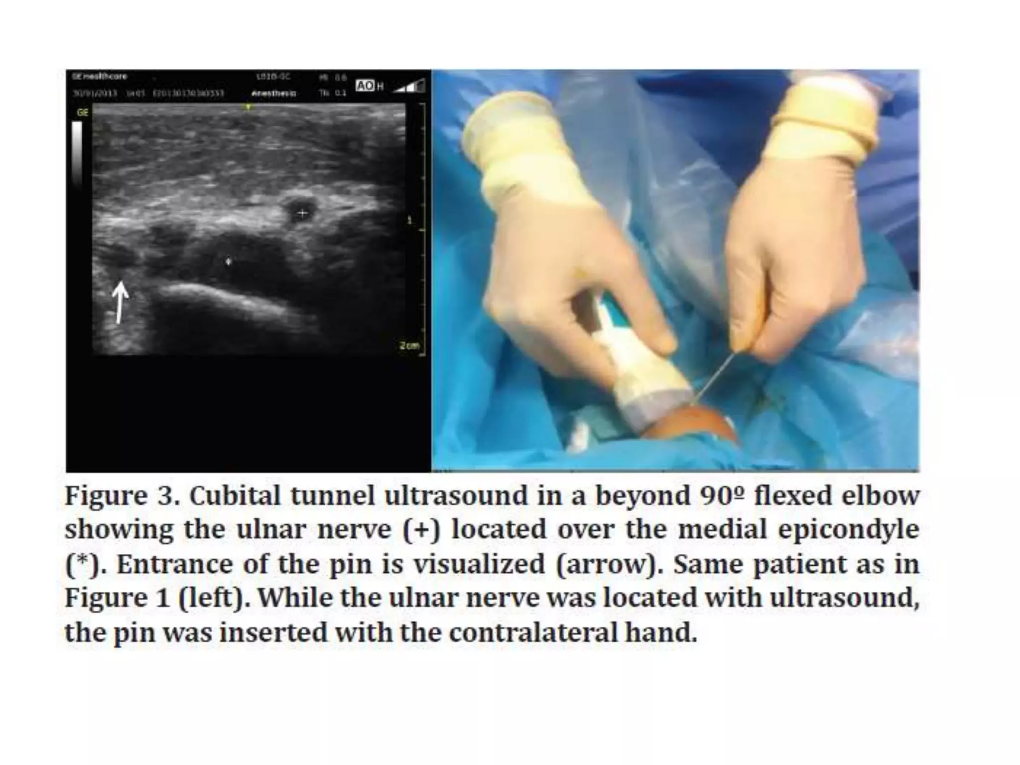 USG guidance for supracondylar fracture of humerus | PPT