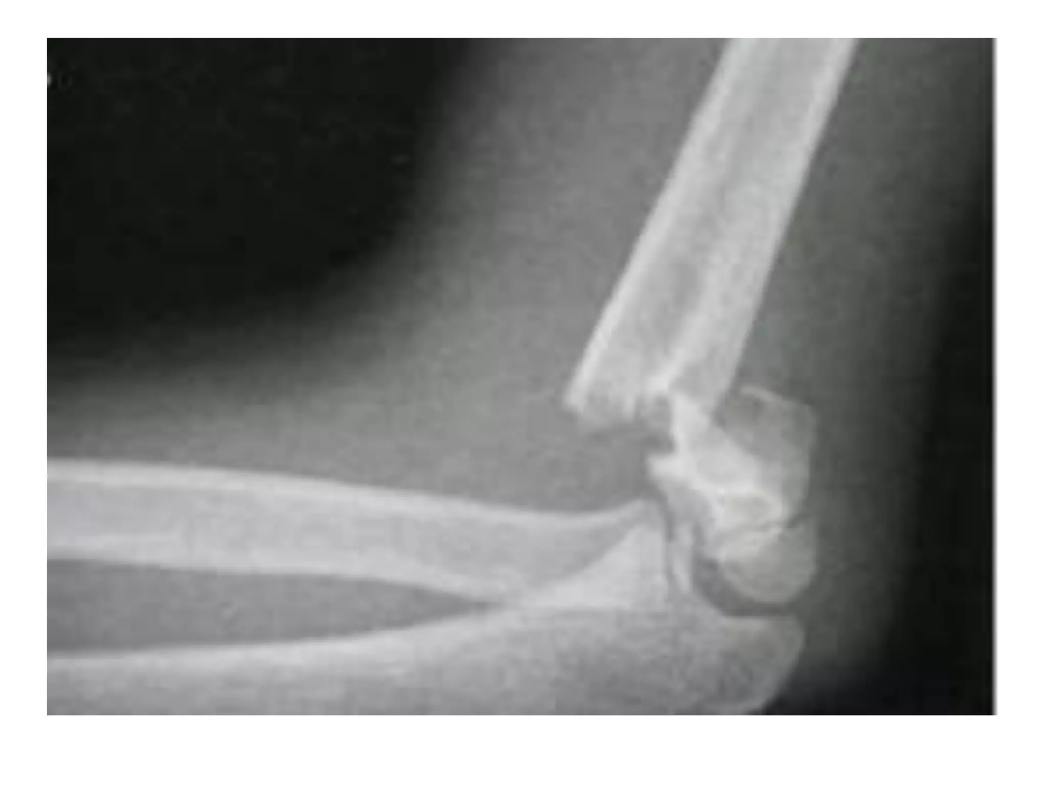 USG guidance for supracondylar fracture of humerus | PPT
