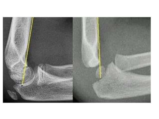 USG guidance for supracondylar fracture of humerus | PPT