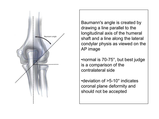 USG guidance for supracondylar fracture of humerus | PPT