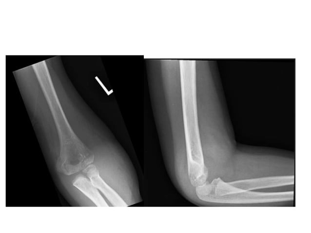 USG guidance for supracondylar fracture of humerus | PPT
