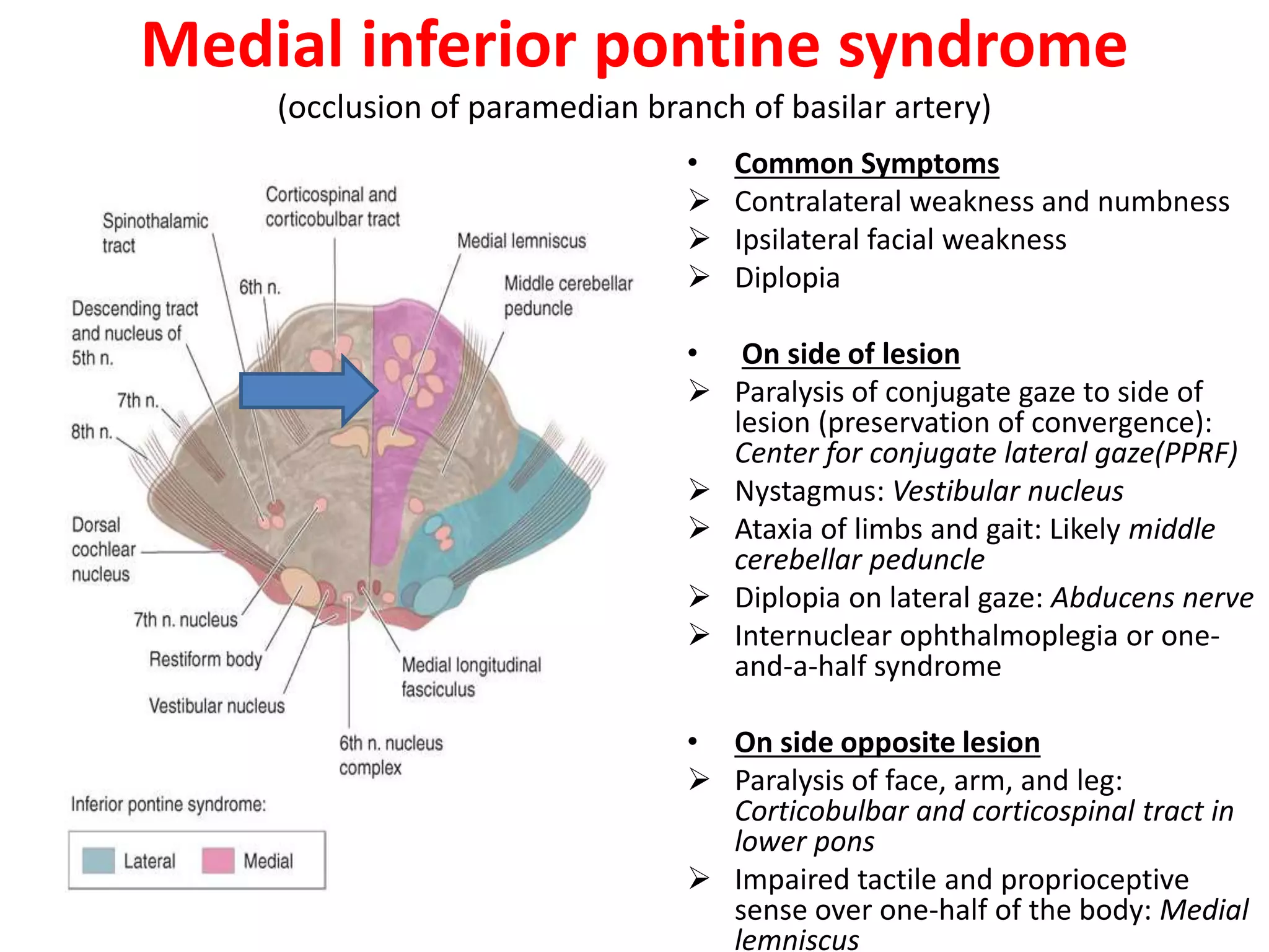 Pons anatomy and syndromes | PPTX